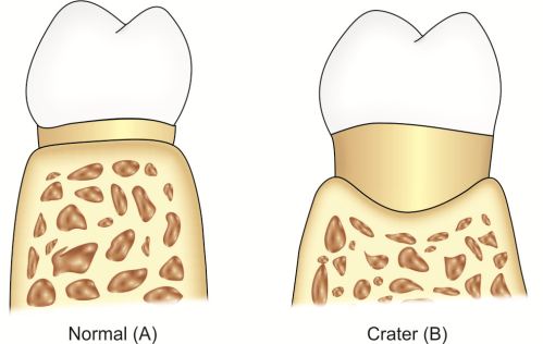 Buttressing Bone Formation Lipping