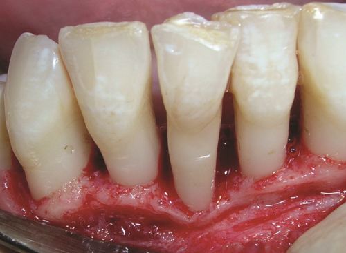 Buttressing Bone Formation Lipping