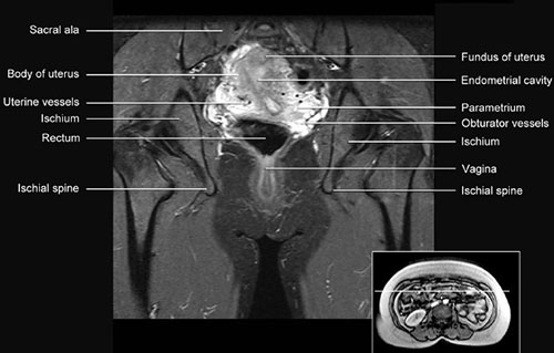 Uterus Anatomy Mri
