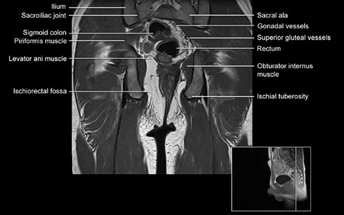 Ischiorectal Fossa Mri