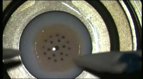 JaypeeDigital | IOCT guided Sutureless patch graft