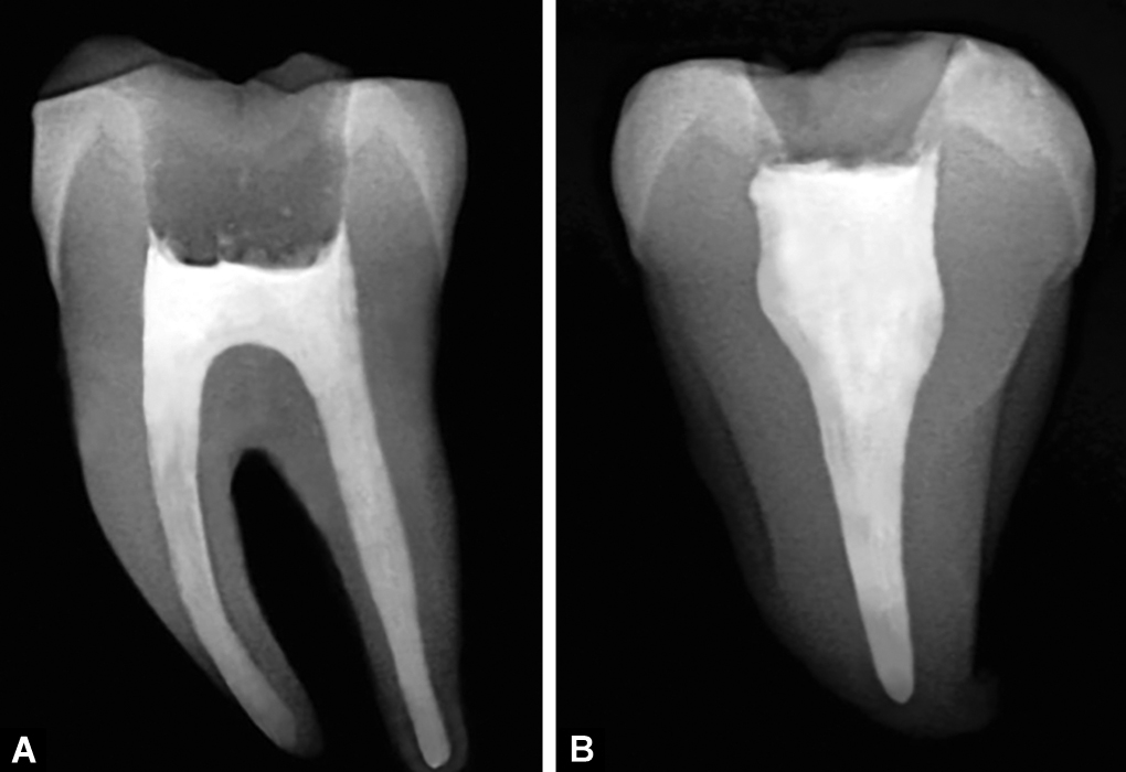 Comparison of Fracture Resistance and Quality of Lateral Condensation ...