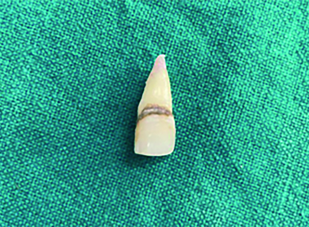 Reimplantation of an Avulsed Tooth with Extra-oral Dry Time More Than ...