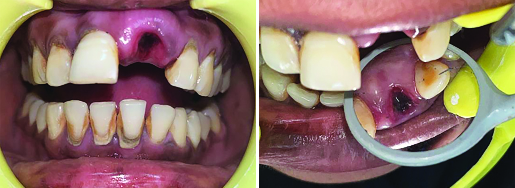 Reimplantation of an Avulsed Tooth with Extra-oral Dry Time More Than ...