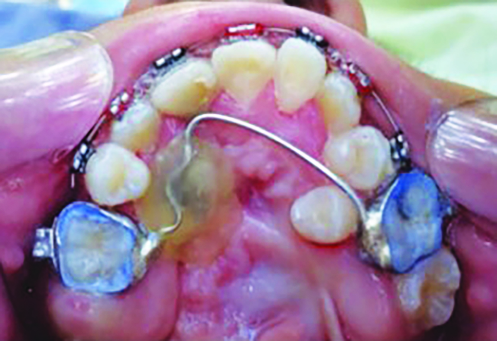 Space Maintainers Redefined: Contemporary Modifications and Trend