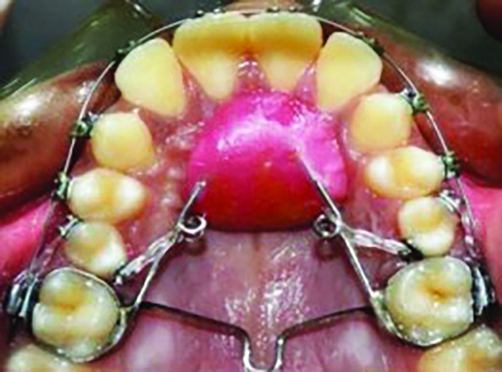 Space Maintainers Redefined: Contemporary Modifications and Trend