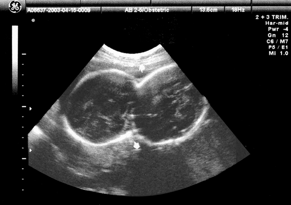 Prenatal Diagnosis of Conjoined Fetuses