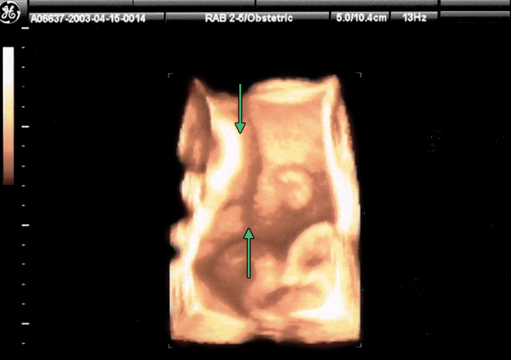 Prenatal Diagnosis of Conjoined Fetuses