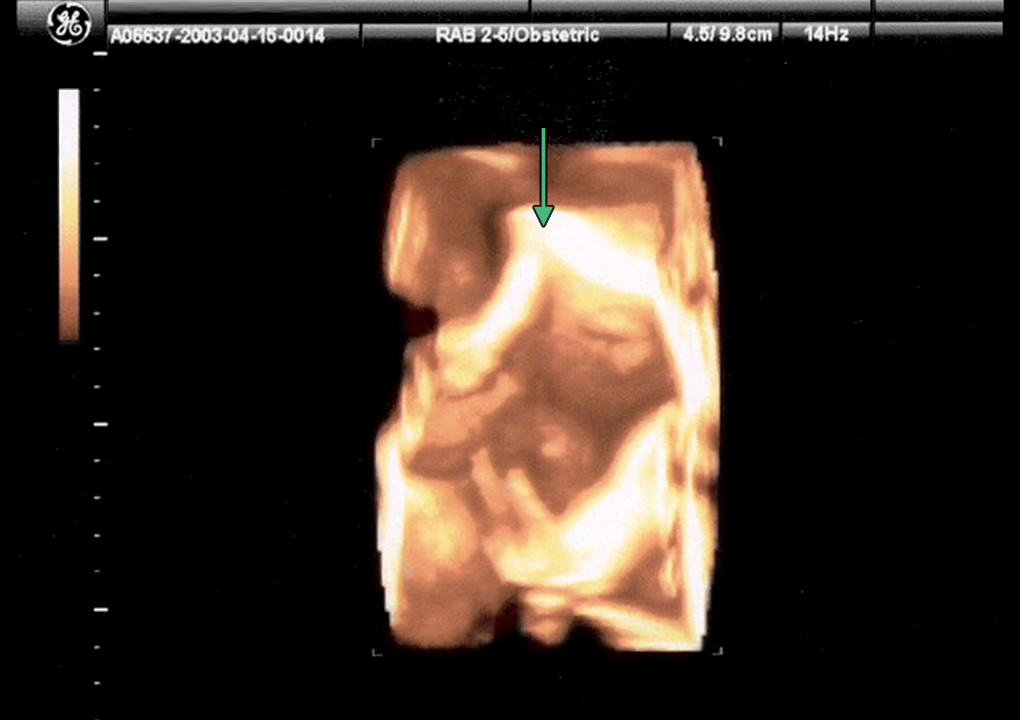 Prenatal Diagnosis of Conjoined Fetuses