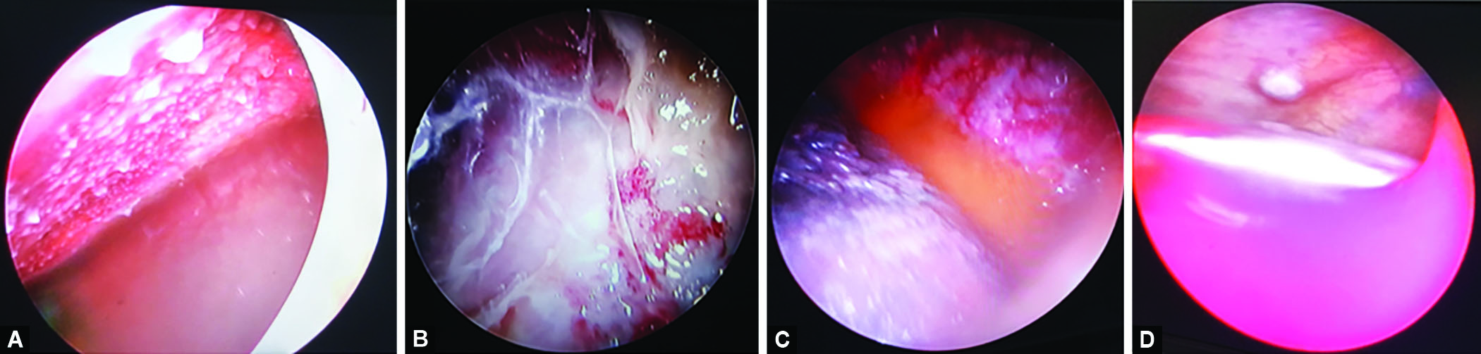 Medical Thoracoscopy: Diagnostic Role in the Management of Undiagnosed ...