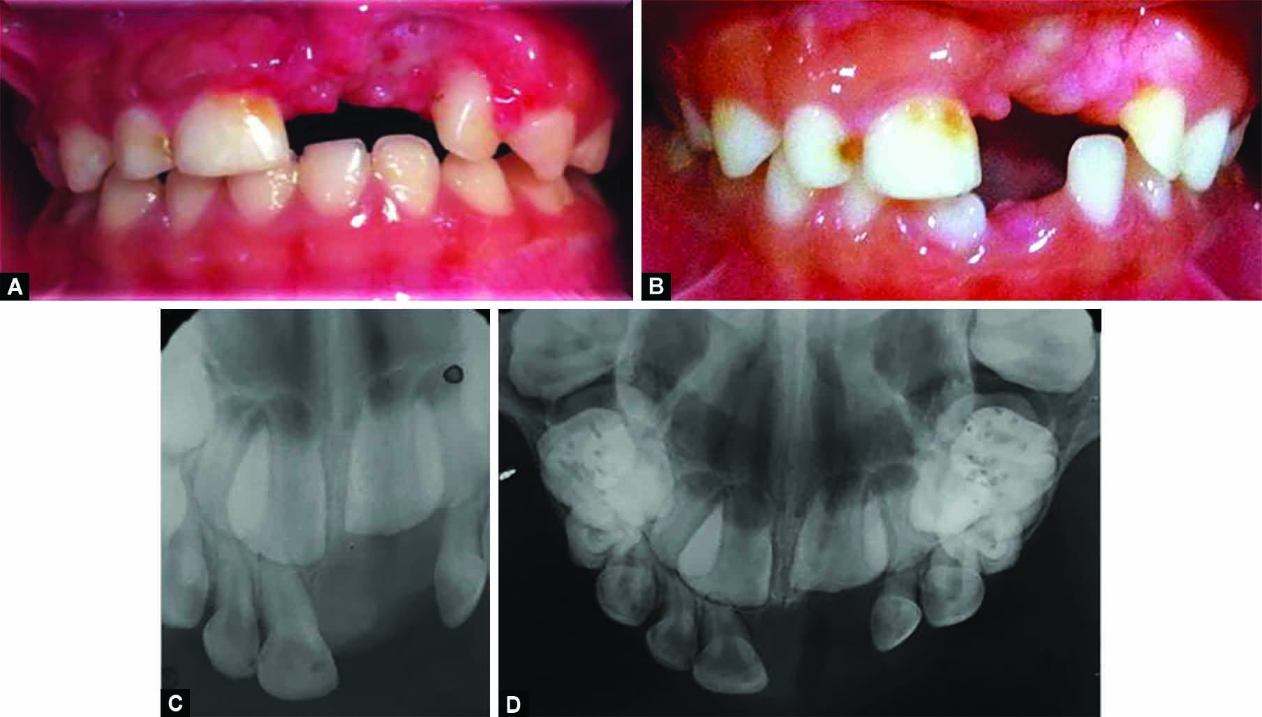 A Rare Gingival Lesion in Children: Fibroepithelial Hyperplasia