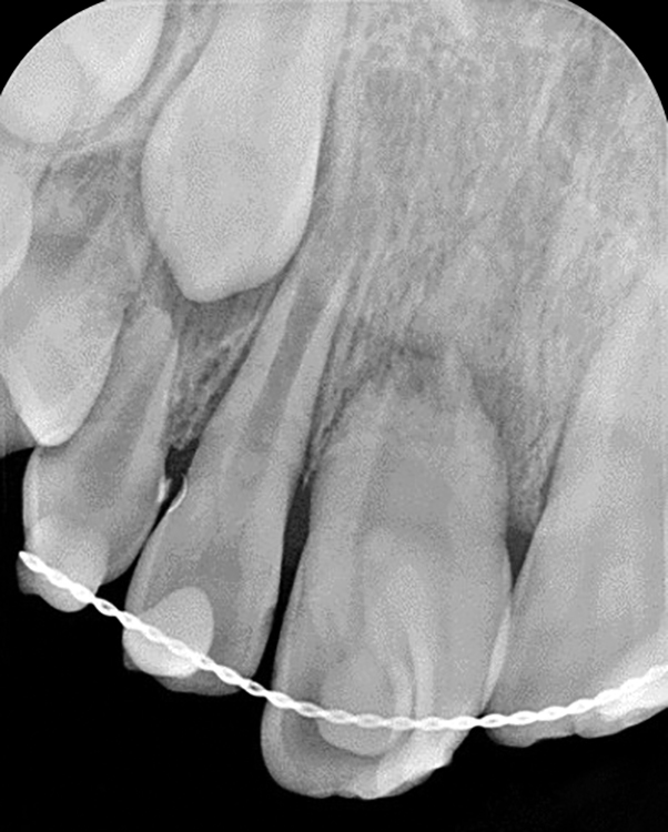 Retreatment of a Failed Regenerative Endodontic Treatment in an ...