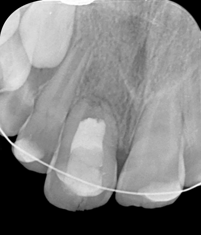 Retreatment of a Failed Regenerative Endodontic Treatment in an ...