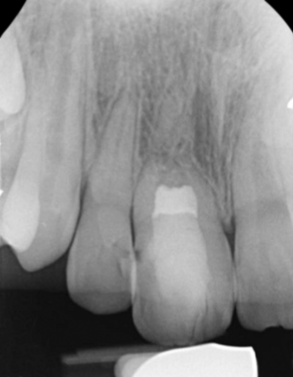 Retreatment of a Failed Regenerative Endodontic Treatment in an ...