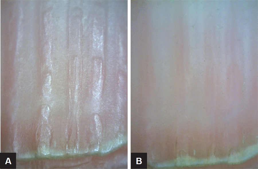 Nail Fold Capillaries