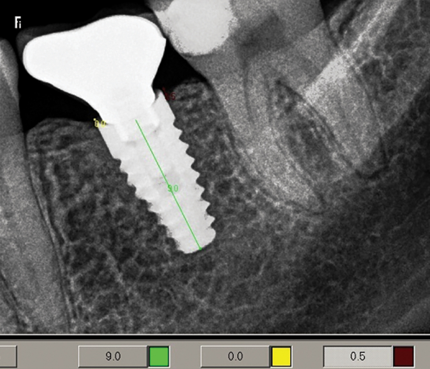 Association of Platform Shifting with Bone Remodeling and Cytokine ...