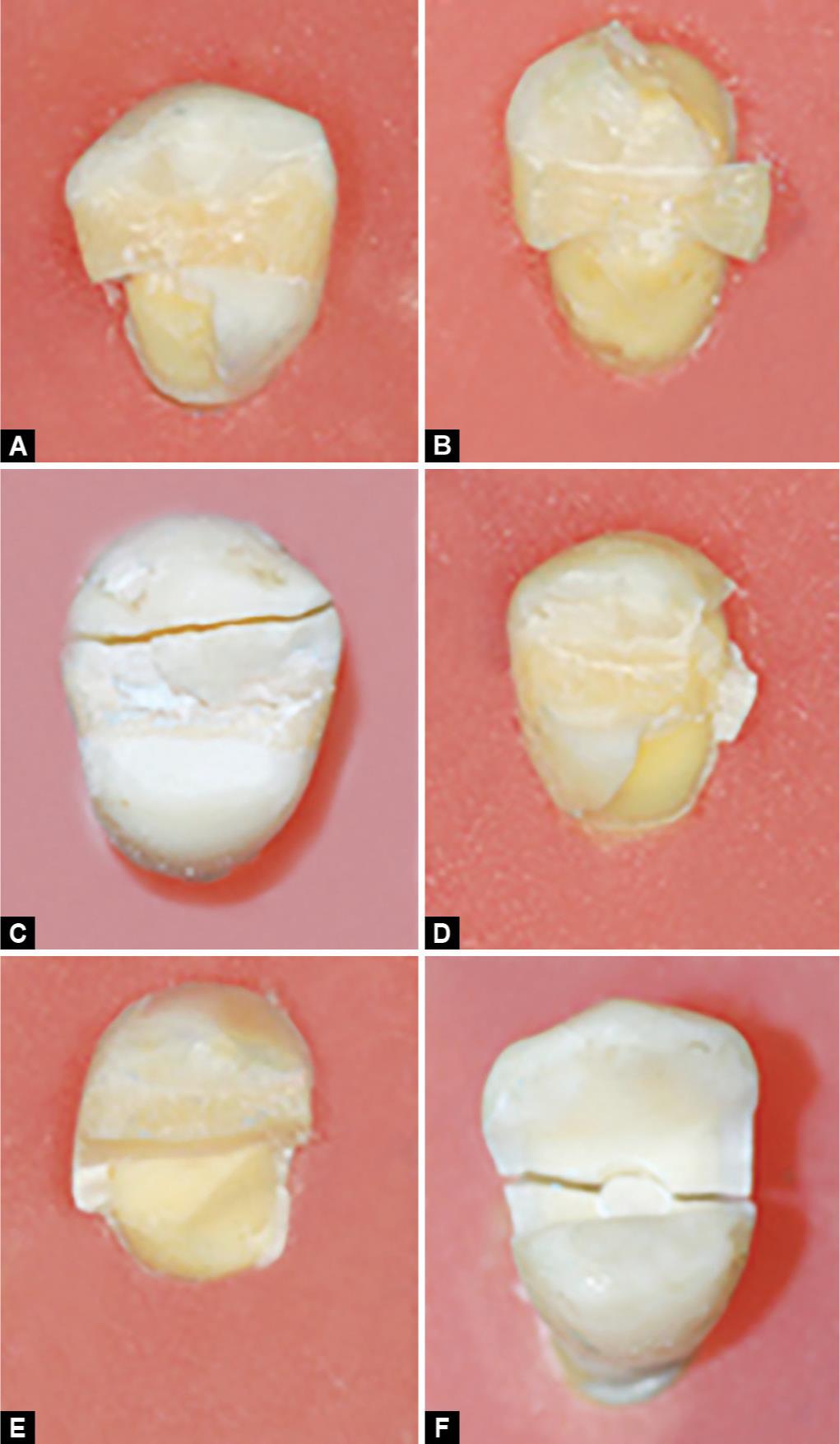 Influence of Cavity Pretreatments on the Fracture Resistance of ...