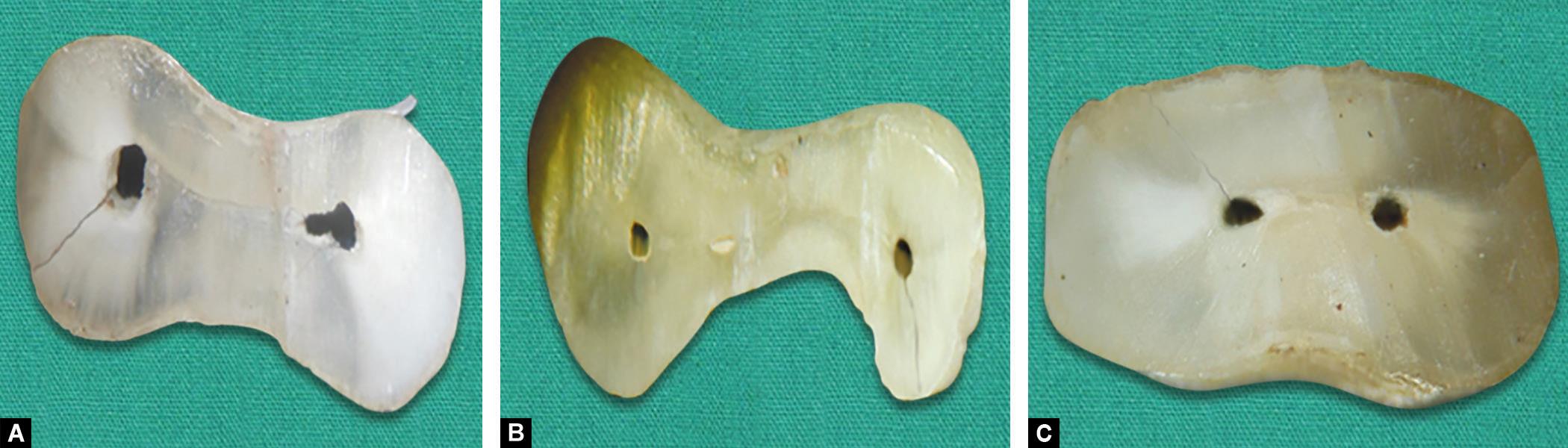 Comparative Analysis of Dentinal Crack Formation Following Root Canal ...