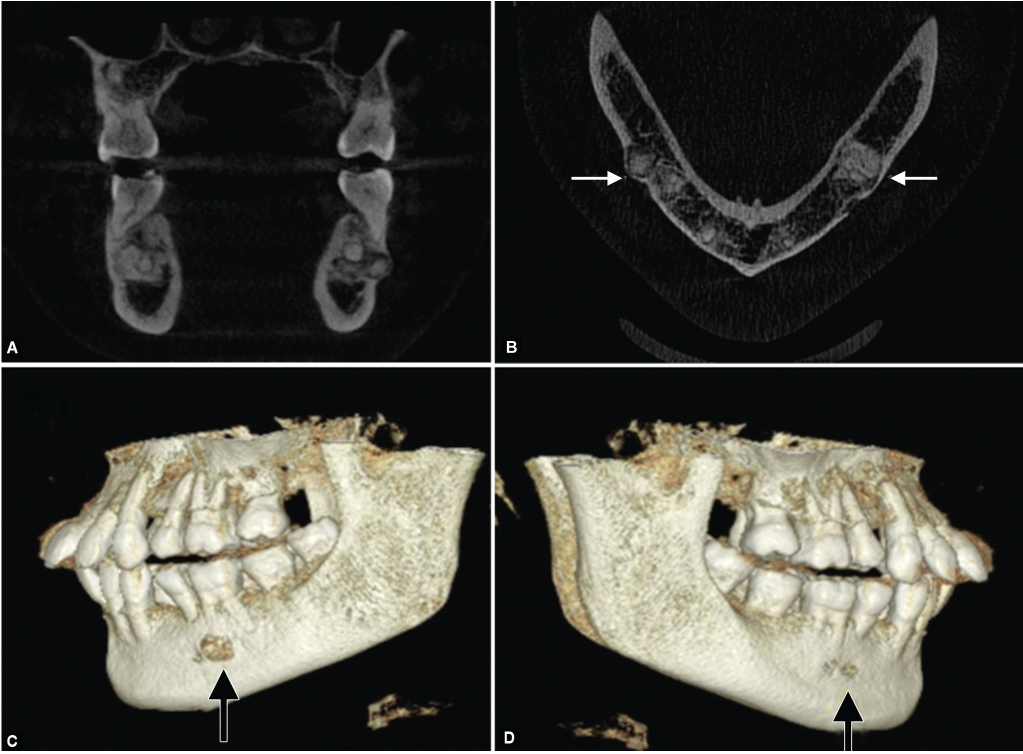 Gigantiform Cementoma