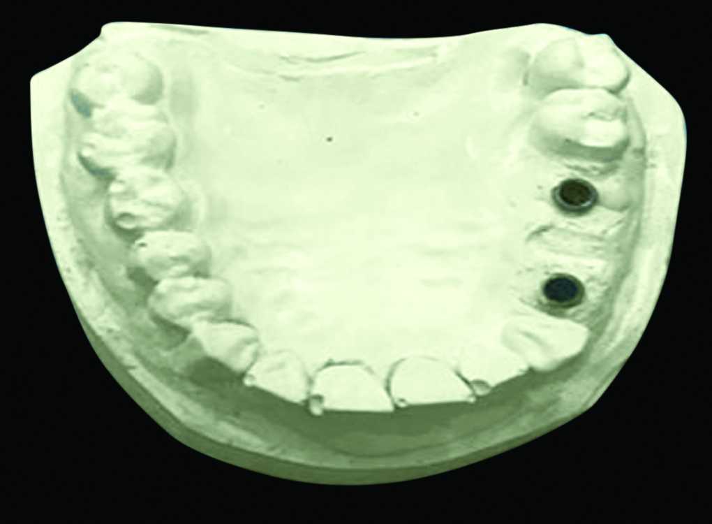 Evaluating the Marginal and Internal Discrepancy of Nickel–Chrome ...