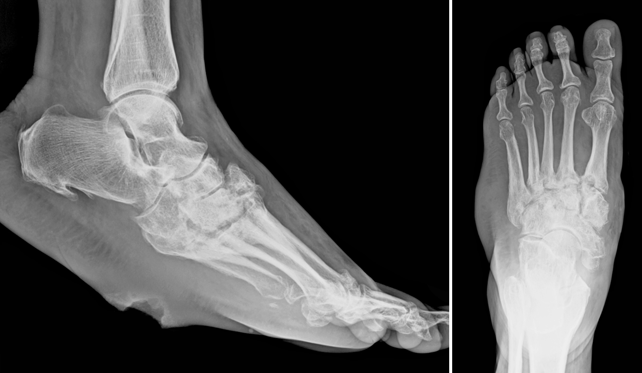 Simple Exostectomy and Tarsal Tunnel Release for a Rocker Bottom ...