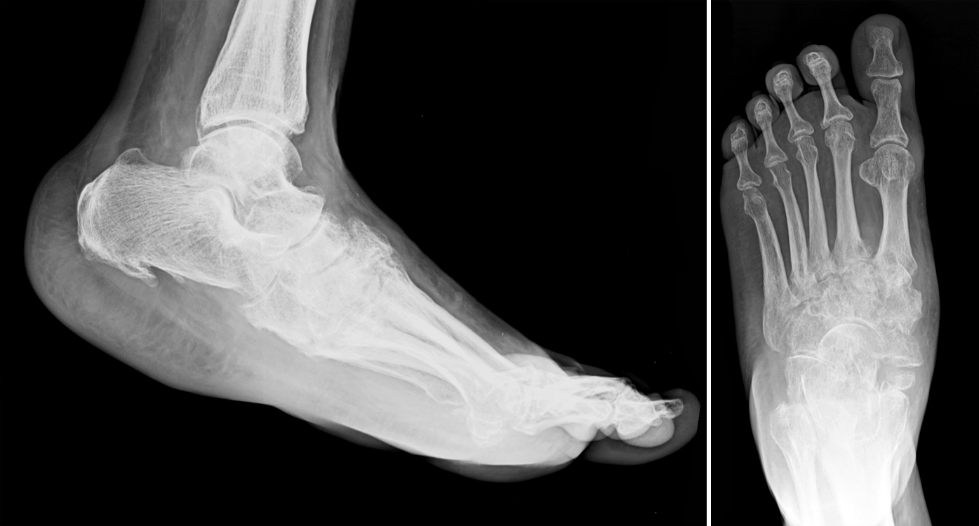 Simple Exostectomy and Tarsal Tunnel Release for a Rocker Bottom ...