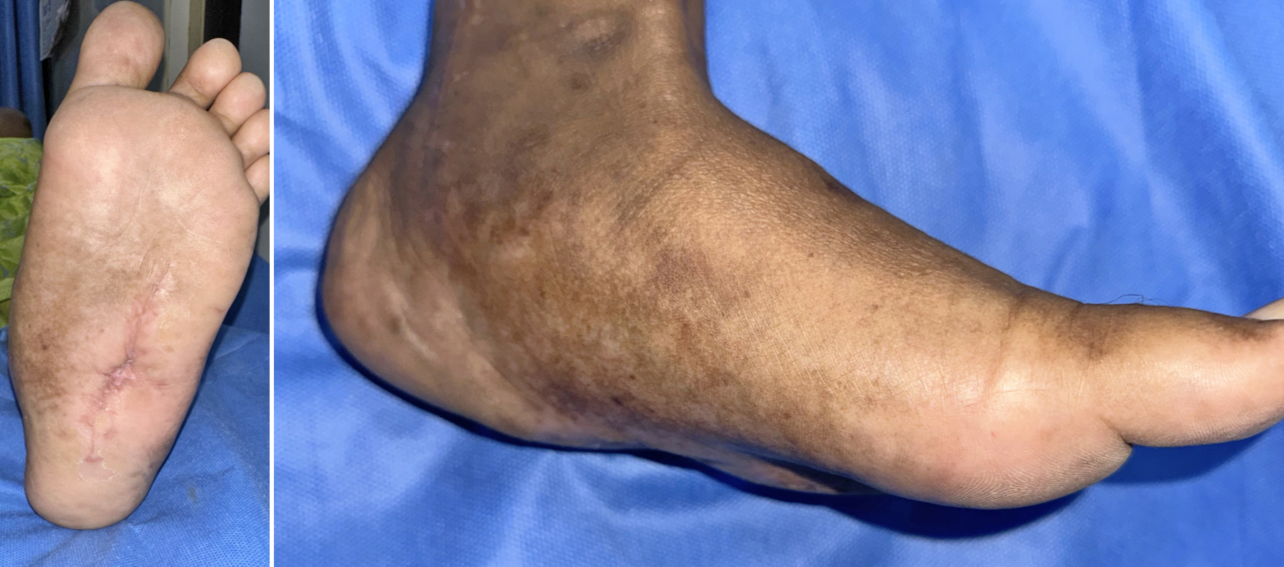 Simple Exostectomy and Tarsal Tunnel Release for a Rocker Bottom ...