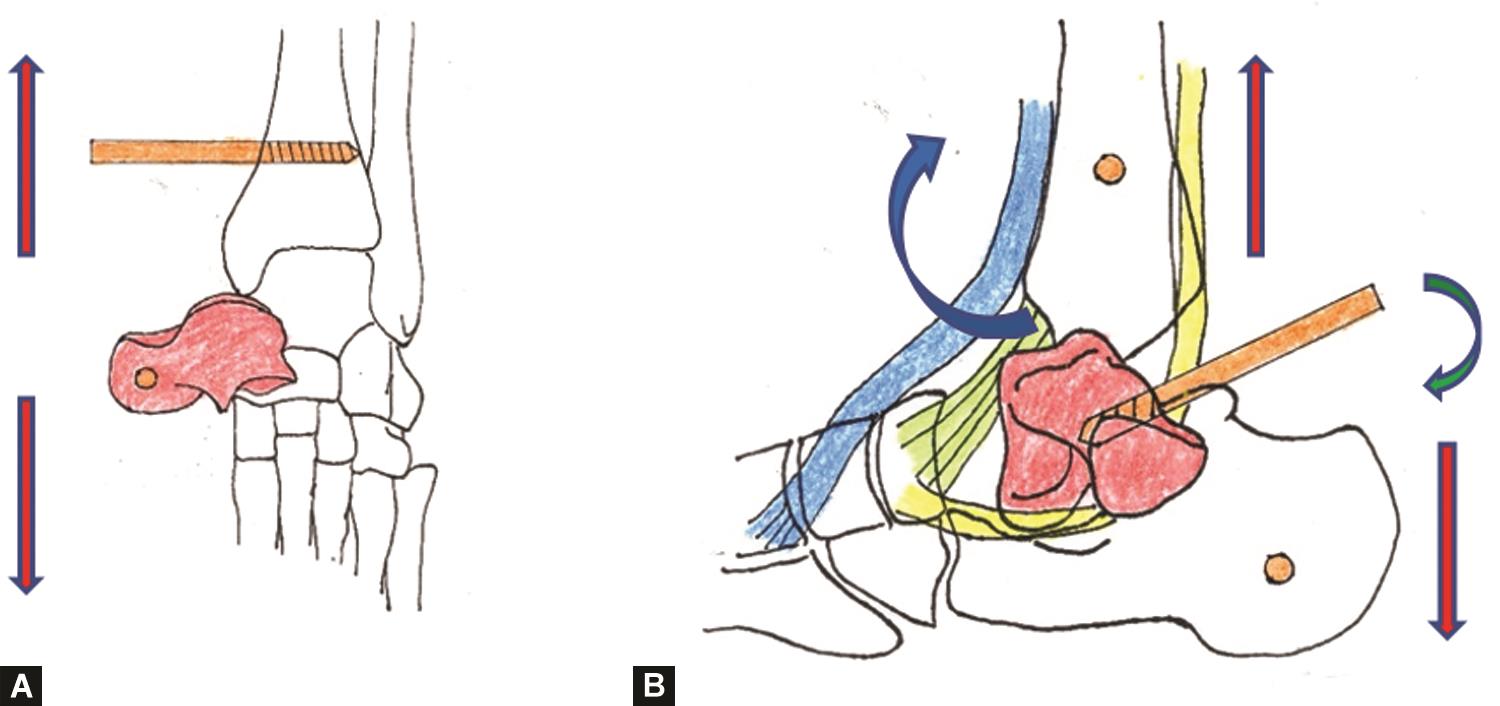Open Total Talar Dislocation with Extrusion: Tips and Tricks in Management