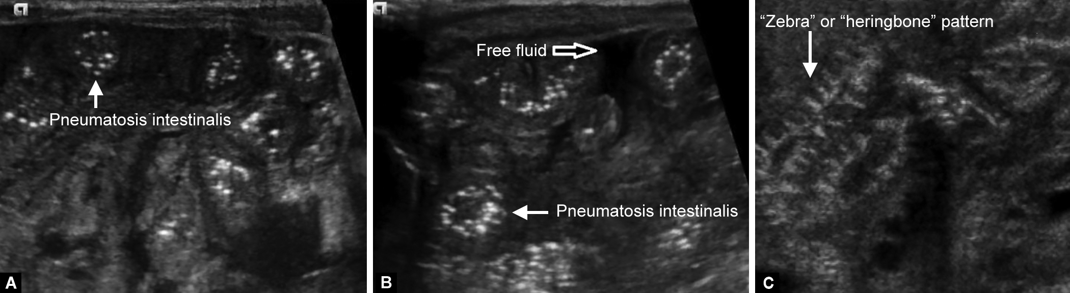Necrotizing Enterocolitis Ultrasound