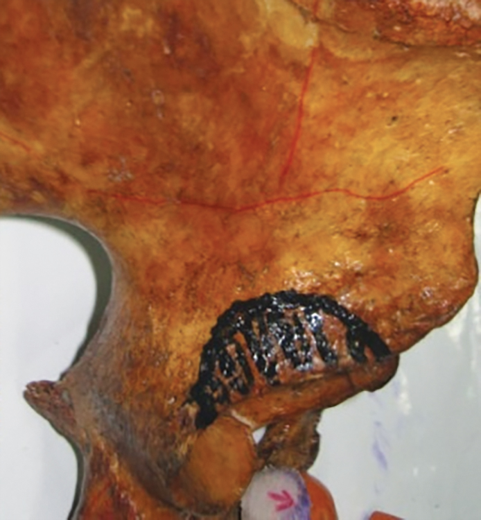 Strategies in Management of Posterosuperior Wall Fracture of the Acetabulum