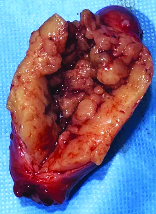 Primary Malignancy of the Salpinx: A Case Series and Review