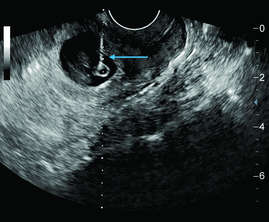 Successful Management Of Cesarean Scar Pregnancy In A Tertiary Care