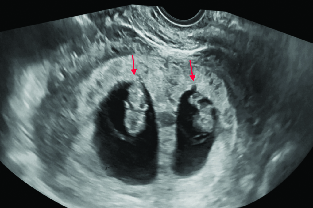 Atypical Presentation of Gestational Trophoblastic Neoplasia Imparting ...