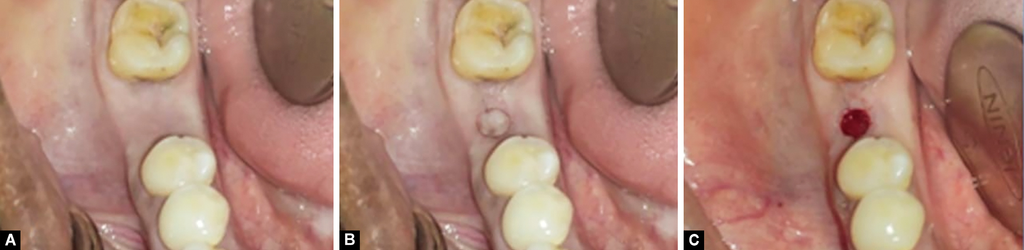 Minimally Invasive Implant Surgery Using Soft Tissue Punch Technique: A ...