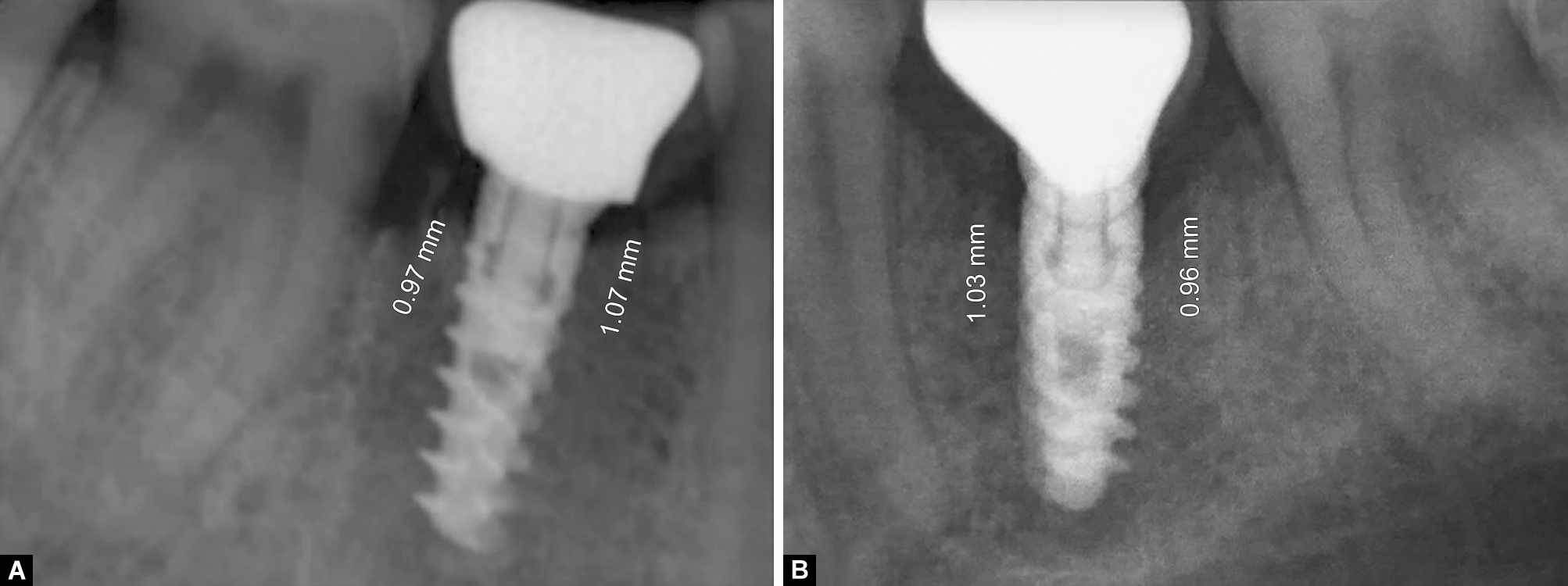 Minimally Invasive Implant Surgery Using Soft Tissue Punch Technique: A ...