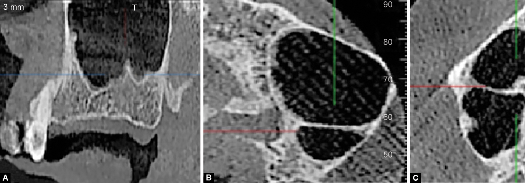 Presurgical Cone-beam Computed Tomography Assessment of Maxillary Sinus ...