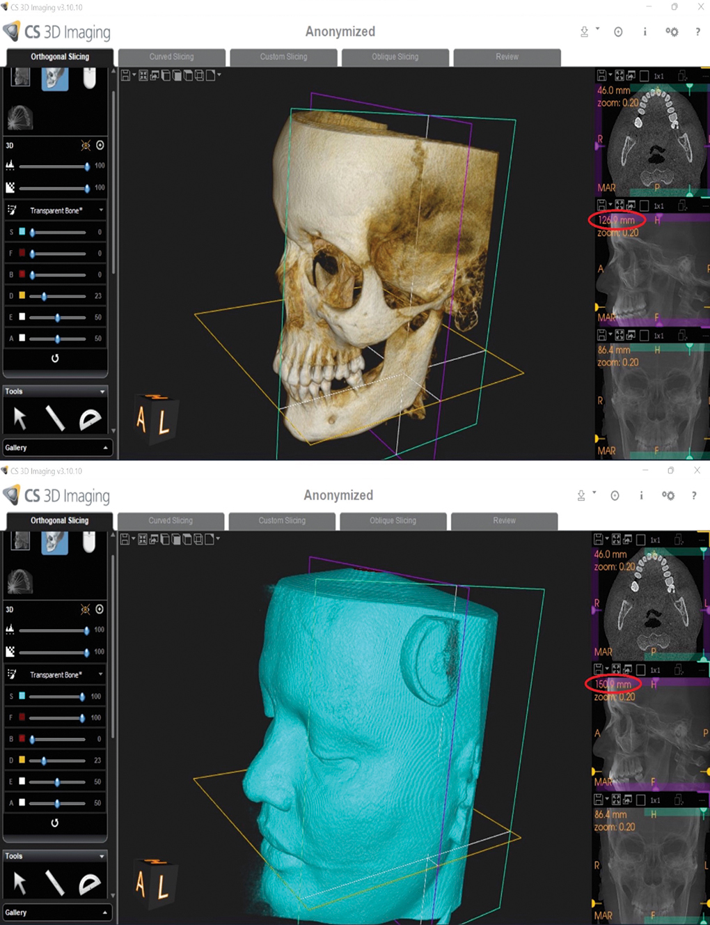 A Cone-beam Computed Tomography Study Evaluating Soft Tissue Thickness ...