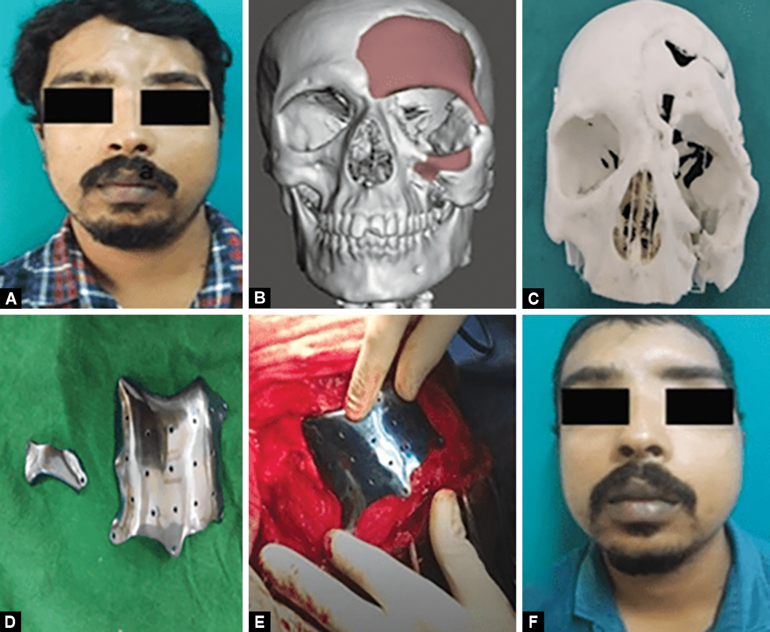 Stereo lithography and Patient-specific Implants in Reconstruction of ...
