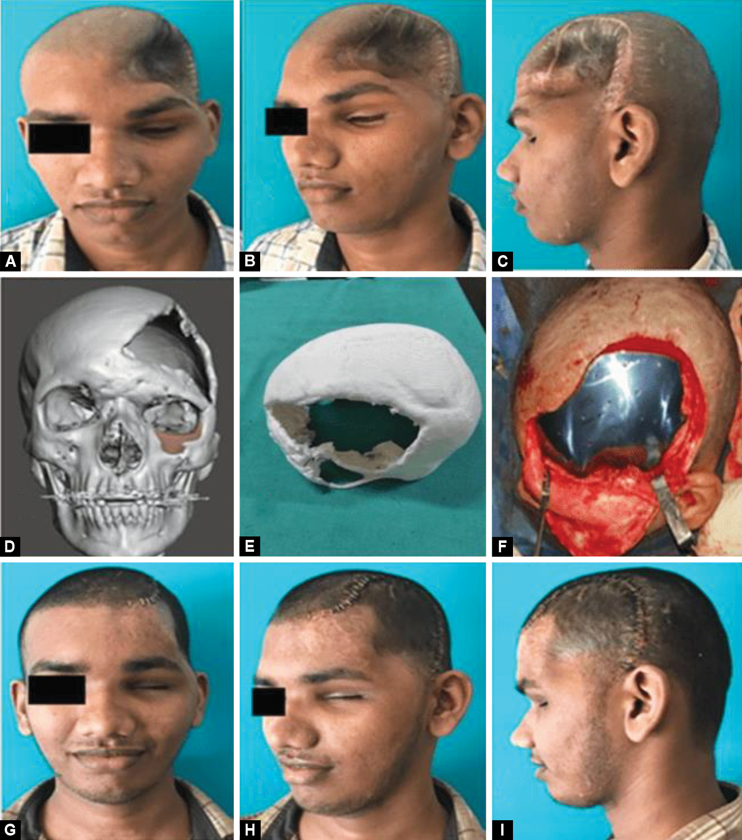 Stereo lithography and Patient-specific Implants in Reconstruction of ...